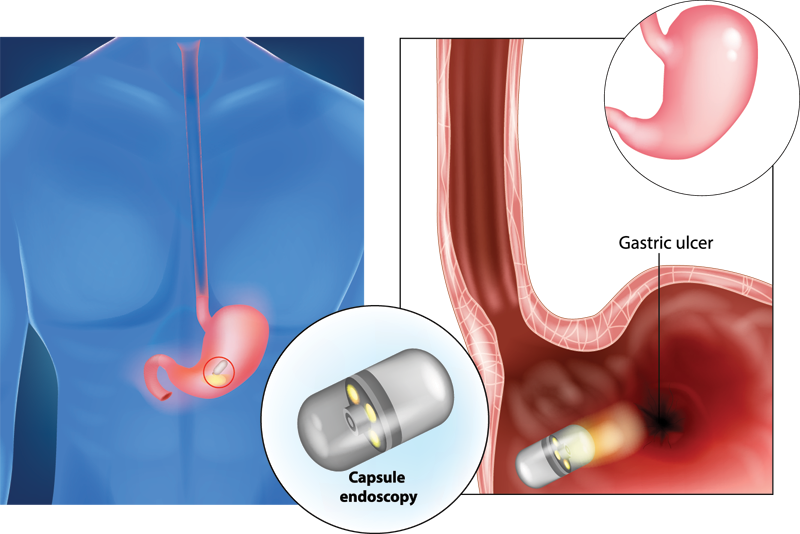 Capsule Endoscopy Capsule Endoscopy